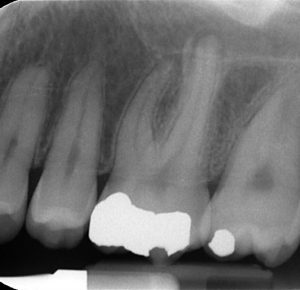 Apexogenesis – Belfast Endodontics