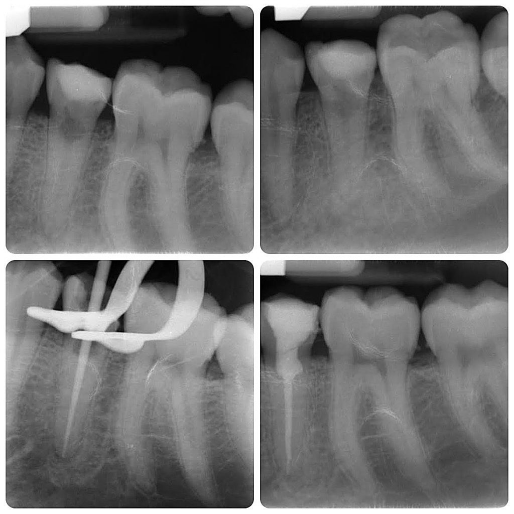 Internal Resorption – Belfast Endodontics