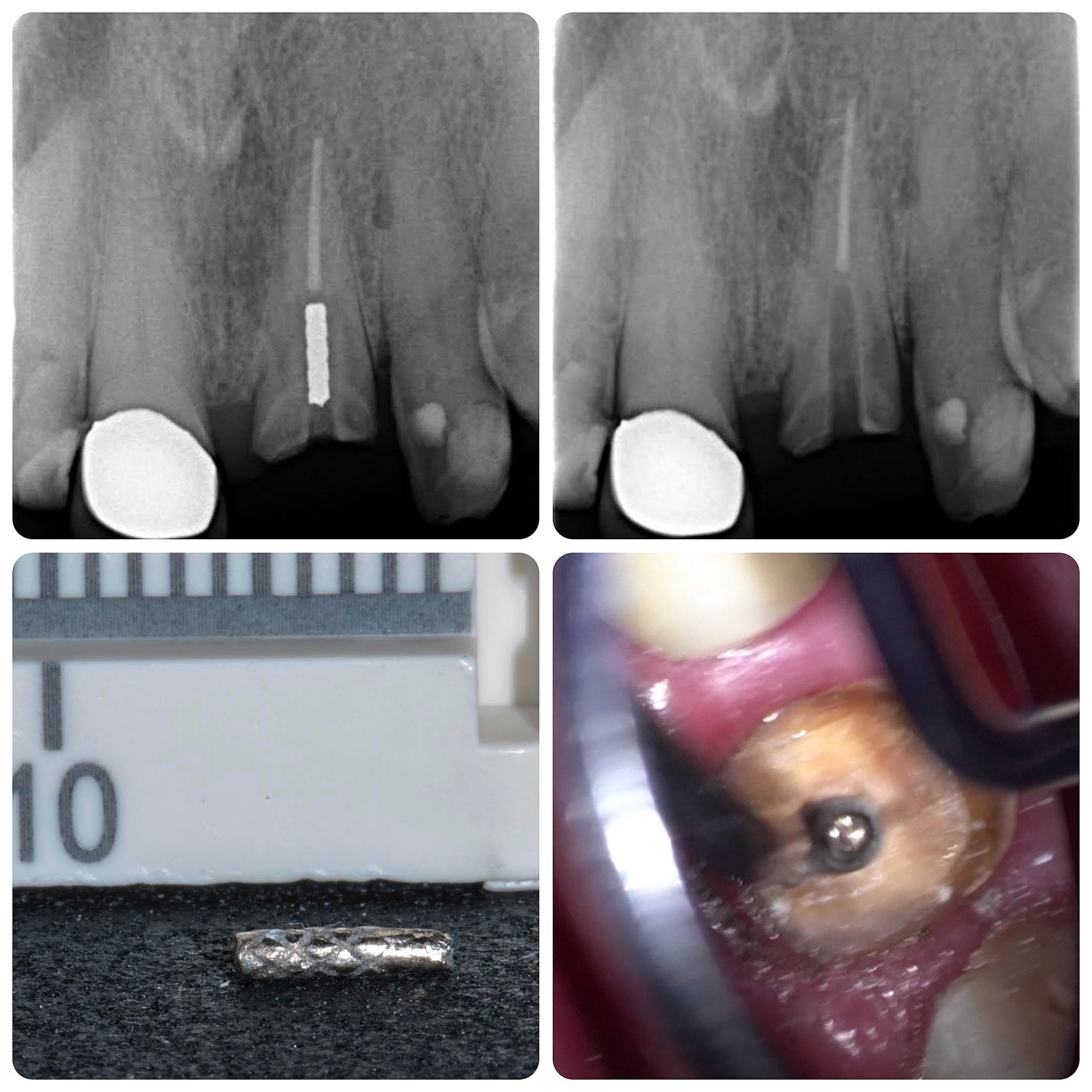 Post Removal – Belfast Endodontics