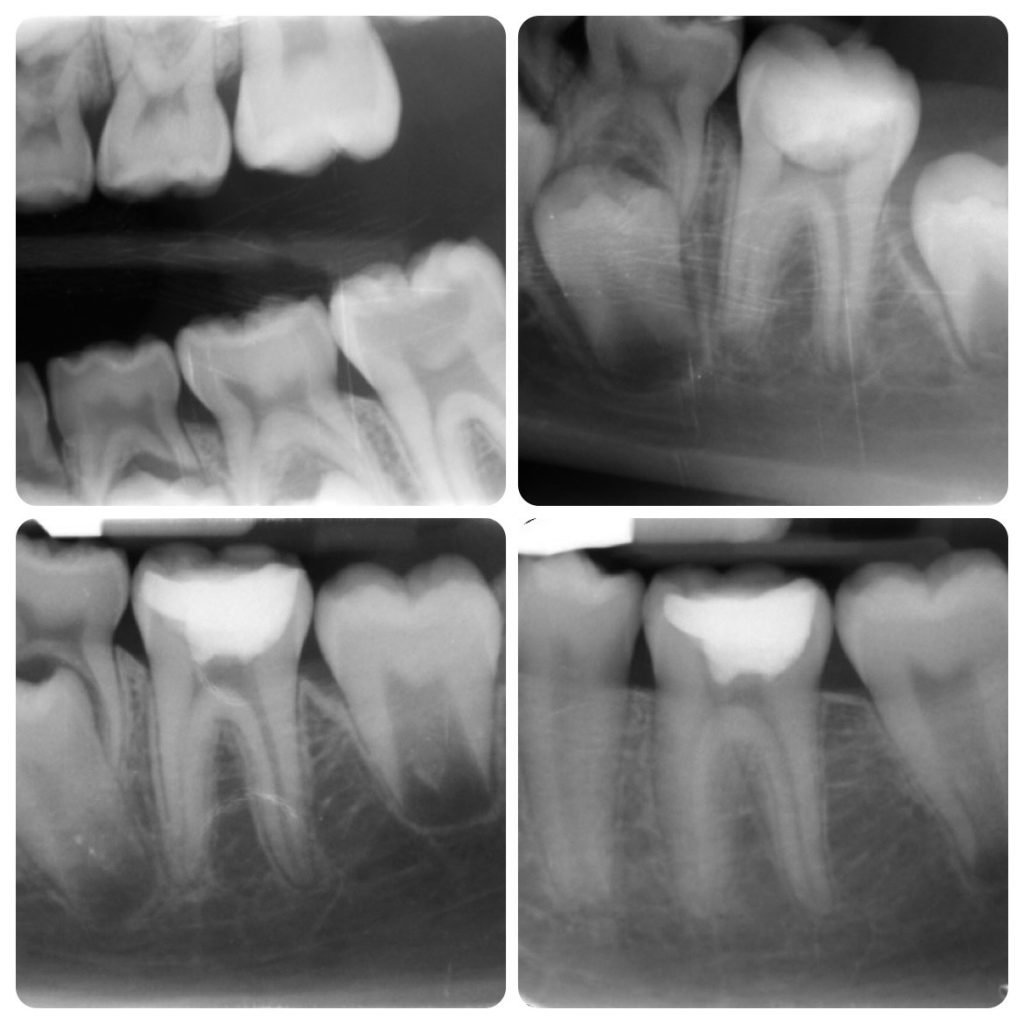 Apexogenesis – Belfast Endodontics